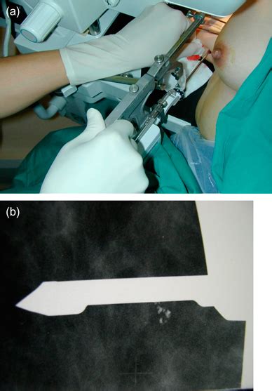 Stereotactic Biopsy