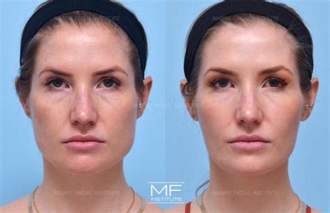 How To Get Defined High Cheekbones With Cheek Filler In San Francisco