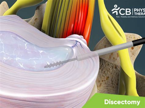 What Is Discectomy Symptoms Causes Diagnosis And Physiotherapy