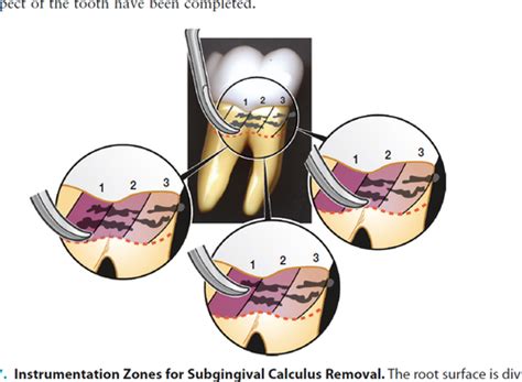 Subgingival Calculus Removal Flashcards Quizlet