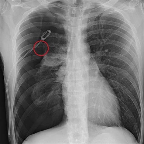 Pdf Primary Spontaneous Pneumothorax Due To High Bleb Burden
