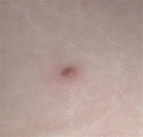 Bcc On My Leg R Skincancer