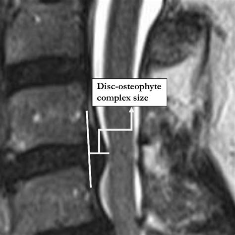 Illustration Of Disc Osteophyte Complex Size Measurement Download