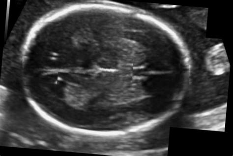 Medical Image Augmentation Semantic Segmentation Model By Fetal Abnormalities