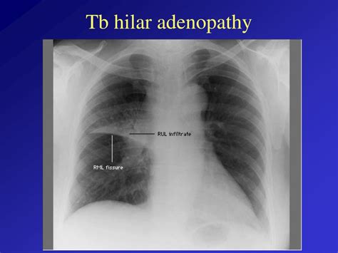Ppt Tuberculosis Powerpoint Presentation Free Download Id 9100749