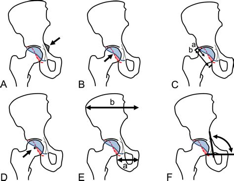 Radiographic Parameters To Evaluate Acetabular Version See Definitions Download Scientific