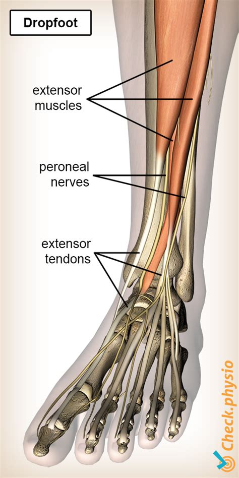 Cause Symptoms And Treatment Foot Drop