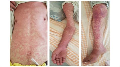 Massive Maculopapular Lesions Covering The Skin Of The Entire Body