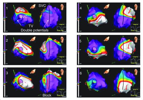 Non Contact Activation Map Of The Right Atrium During Counterclockwise