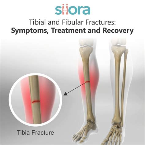 Tibia And Fibula Fracture Types