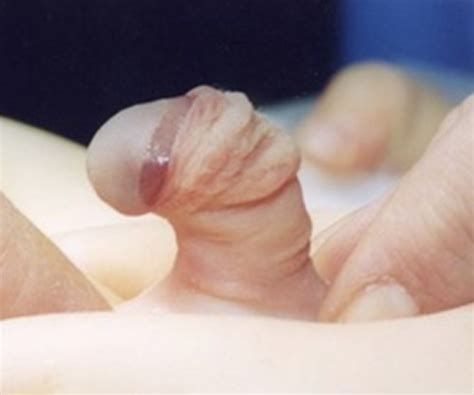 Penile Abnormalities Flashcards Quizlet