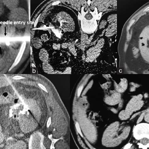 A D Computed Tomography Imaging In Axial Section Showing Wedge Shaped Download Scientific