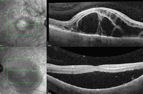 Serous Retinal Detachment Oct