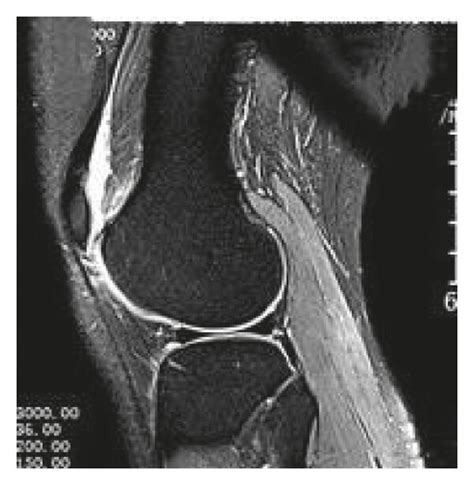 Mri Image Of Meniscus A Mri Image Of Normal Meniscus B Mri Image