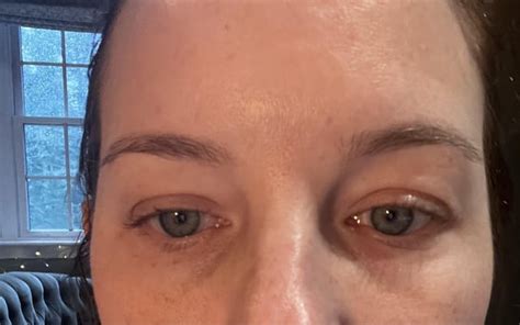 Upper Bleph R 30plusskincare