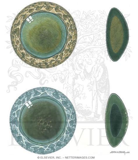 Types Of Senescent Senile Cataracts