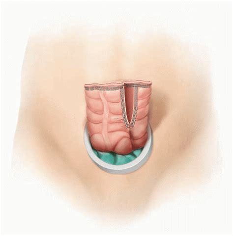 Laparoscopic Transverse Colectomy Basicmedical Key