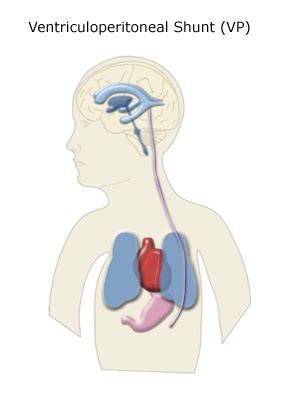 Fetal Hydrocephalus