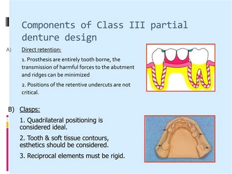Designing For Kennedys Cl Iii And Iv Ppt