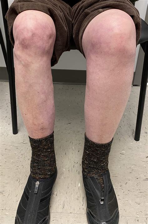 Deep Vein Thrombosis Dvt Bevsa Buffalo Endovascular And Vascular