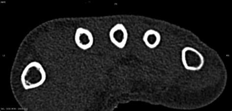 Shapes Of The Medullary Cavity From 1 To 5 Metacarpal At Midshaft Level