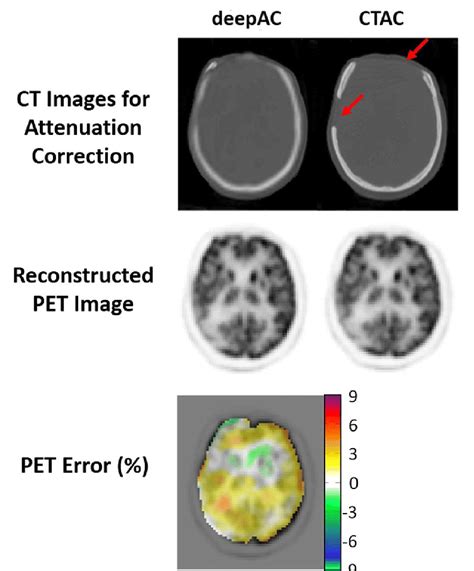prediction of missing parts in the skull by dl based pseudo ct