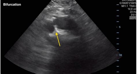 Iliac Artery Aneurysm Ultrasound 1 Annotated Jetem 2020 Jetem