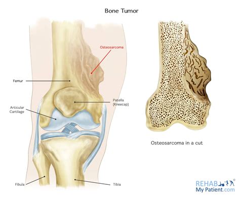 Bone Tumor Osteochondroma Rehab My Patient