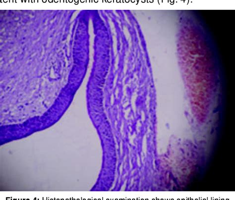 Figure 1 From Gorlingoltz Syndrome Incidental Finding In Patient With
