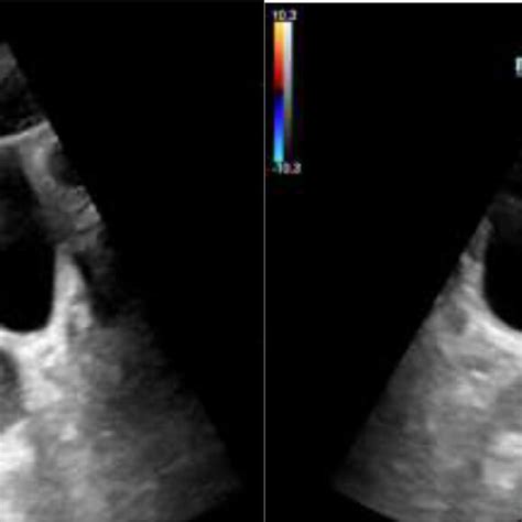 Mri Coronal Section Showing Dilated Right Seminal Vesical With Mild