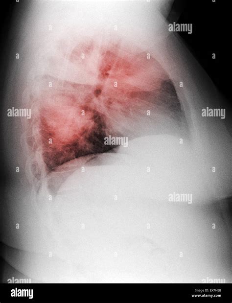 Chest X Ray Showing Diffuse Interstitial Infiltrates Suggestive Of An Atypical Pneumonia Stock
