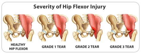 Hip Flexor Treatment