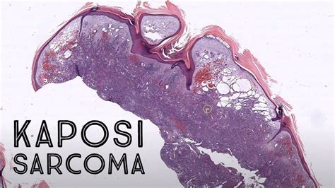 Kaposi Sarcoma Nodular Tumor Stage Hhv 8 Hiv Aids Pathology Dermpath Dermatology Youtube