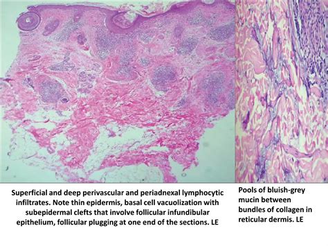 Interface Dermatitis Tutorial Pptx