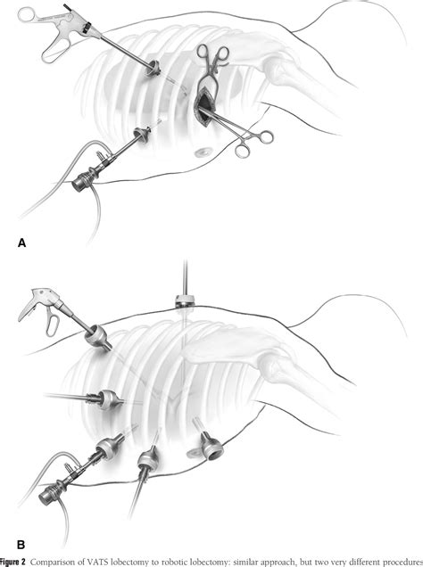 Figure 2 From Robotic Lobectomy Semantic Scholar