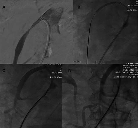 A B Percutaneous Intervention And Stent Implantation Of Superior