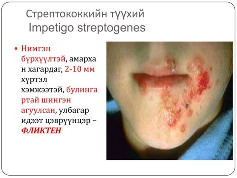 арьсны идээт өвчнүүд Pptx