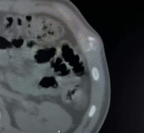 Dr Aaqib Javid On Linkedin Osteochondroma At Costochondral Junction Usually Benign Risk Of…