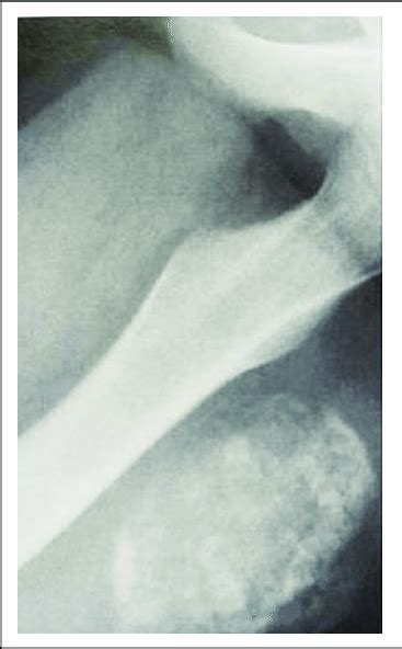 C Post Traumatic Heterotopic Ossification Download Scientific Diagram
