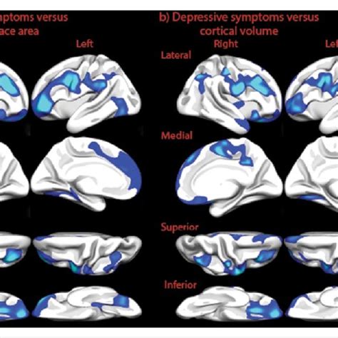 Differences In Cortical Structure Between Patients And Controls The Download Scientific