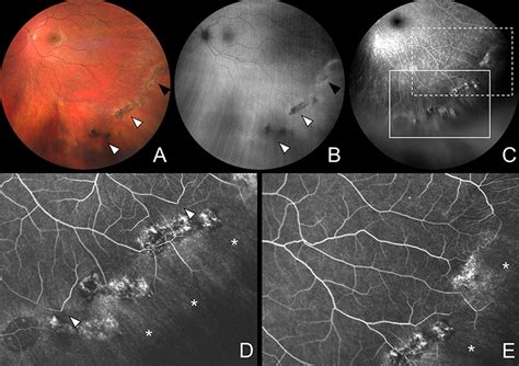 Spotlight On Lattice Degeneration Opth