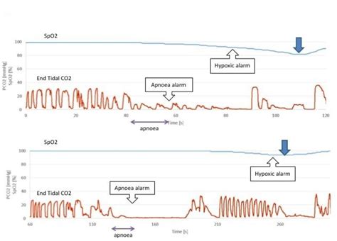 Novel Mainstream Capnometer System Is Safe And Feasible Even Under Co2