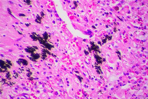 Viral Pneumonia Disease Human Cells By Stocksy Contributor Pansfun