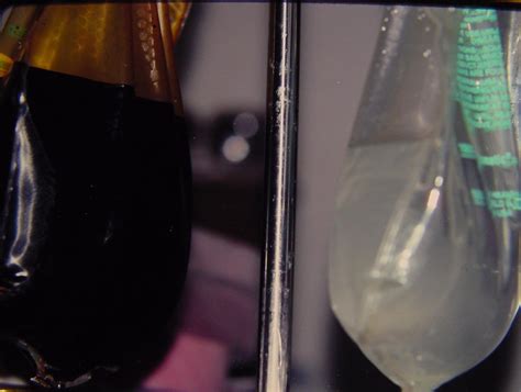 Echinococcal Cyst Surgery Photos