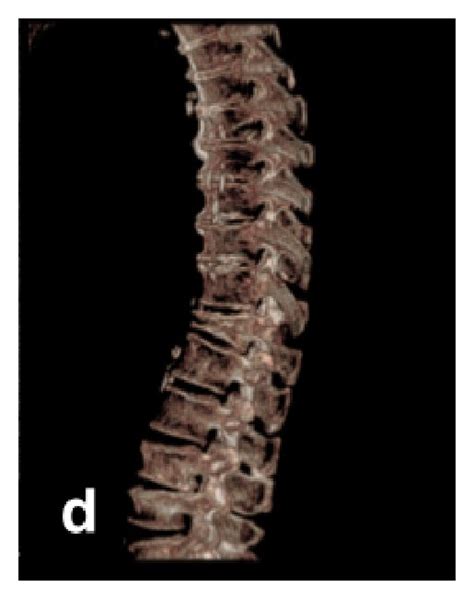 Computed Tomography Of Thoracic Spine In A Sagittal B Coronal And Download Scientific