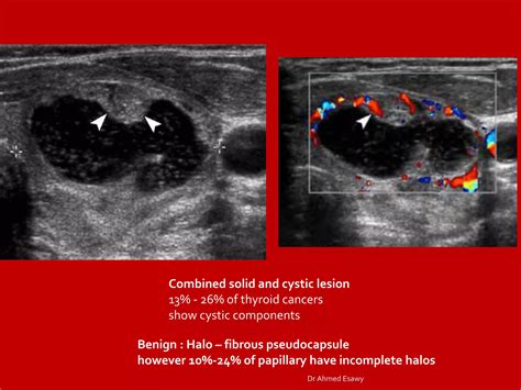 Thyriod Gland Imaging Part 3 Benign Malignant Thyriod Nodule Dr Ahmed
