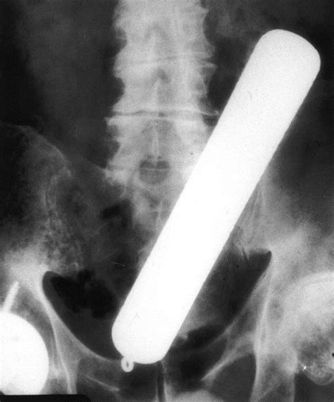 Novel Endoscopic Approach For Removal Of A Rectal Foreign Body
