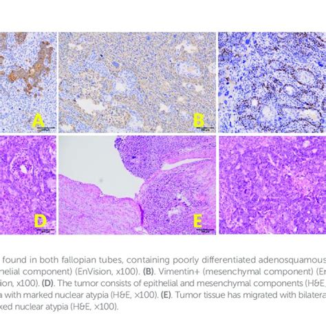 Preoperative Ultrasound Findings A Transabdominal Ultrasound