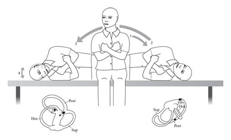 Benign Paroxysmal Positional Vertigo Bppv History Pathophysiology