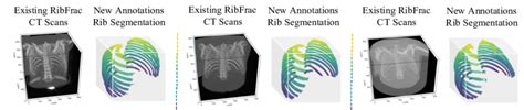 Illustration Of Ribseg Dataset 490 Ct Scans From The Existing Ribfrac Download Scientific